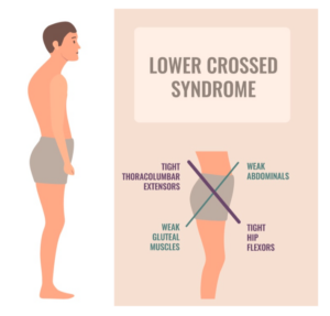 Lower crossed syndrome - Altius Healthcare